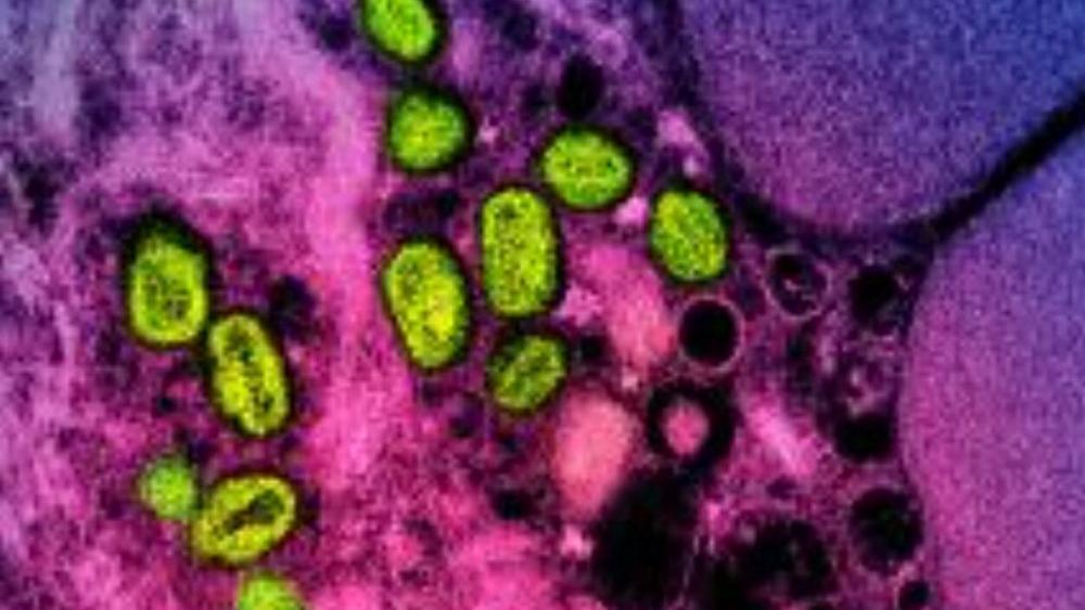Affenpockenvirus Mpox jetzt in Europa: Das sind die Symptome und ...